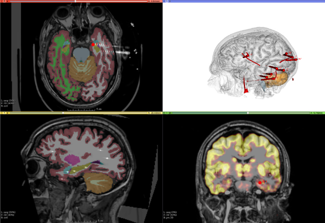 Stereoelectroencephalography (SEEG) - Epilepsy Unit - Hospital del Mar
