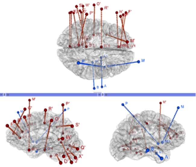 Stereoelectroencephalography (SEEG) - Epilepsy Unit - Hospital del Mar